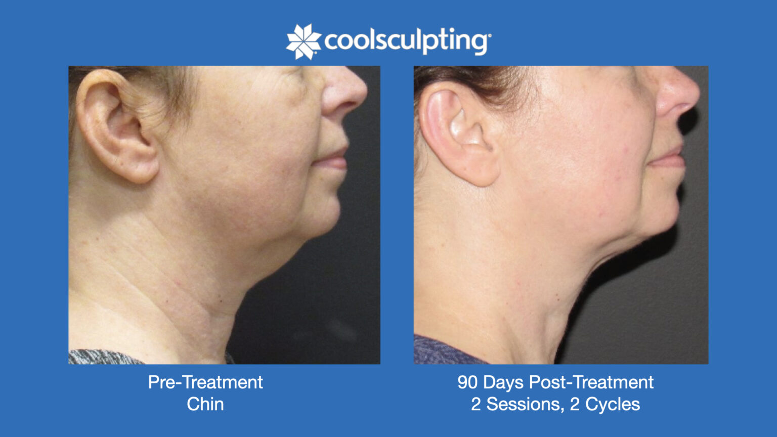 Coolsculpting | Body Sculpting | Near Me | Bel Air MD | Harford County ...